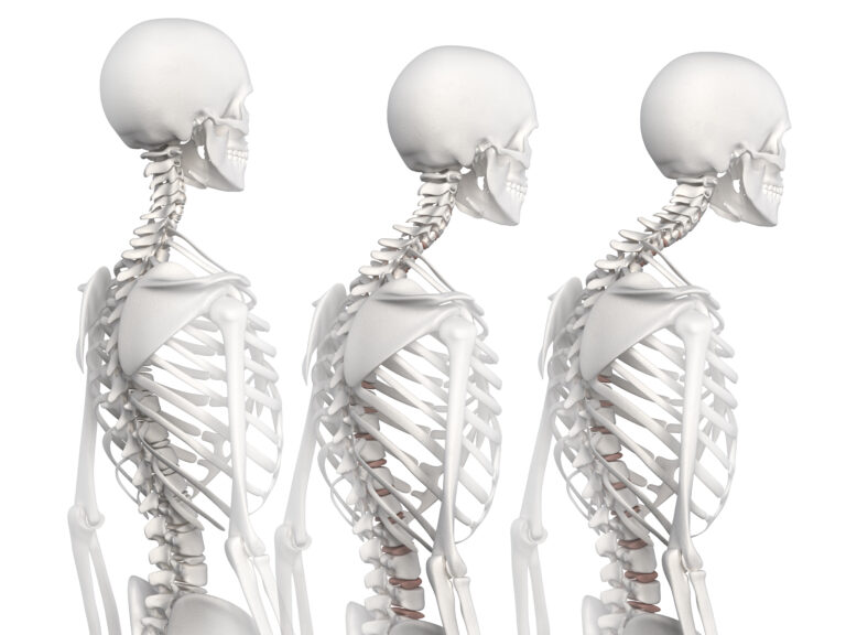 What is Forward Head Posture? And Can It Cause Neck Pain